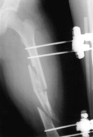 Femoral Shaft Fractures - Pediatric - Pediatrics - Orthobullets